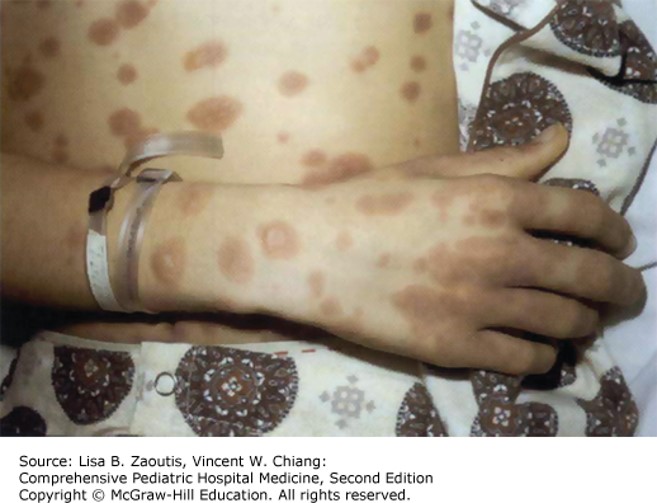 Fever and Rash Diagnosis | AccessMedicine Network