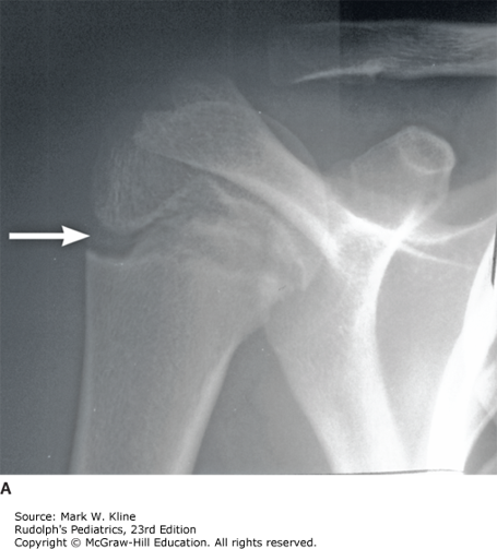 A 15-year-old boy presents to your office with insidious onset of right ...