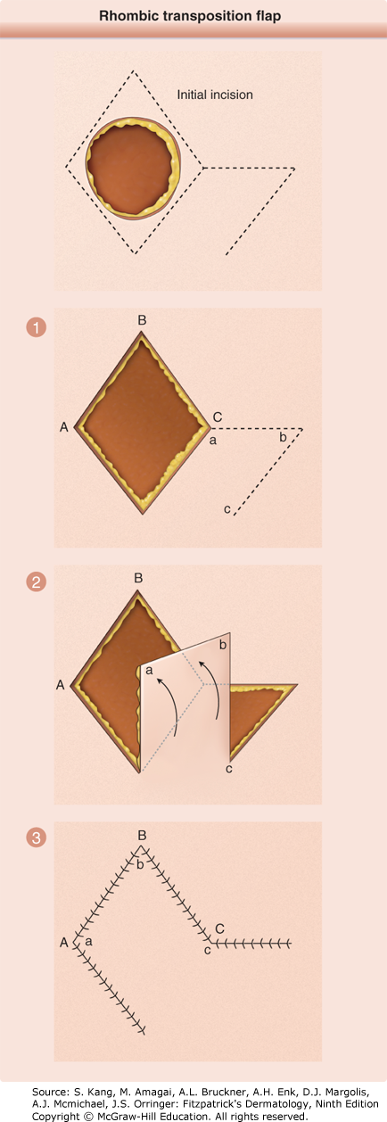 Dermatology Question of the Week: Surgical Skills | AccessMedicine Network