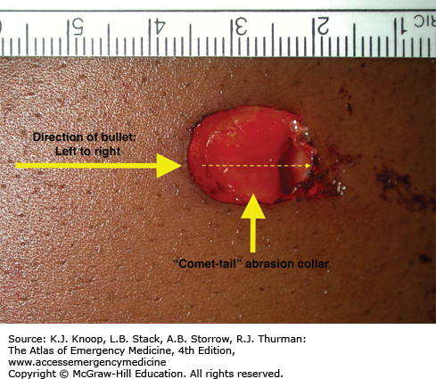 Entrance vs. Exit Gunshot Wounds | AccessMedicine Network