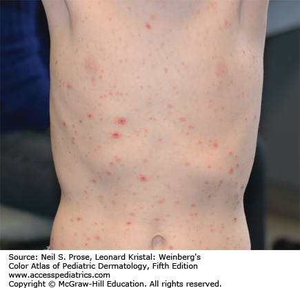 Dermatology Question of the Week: Pediatric Problems | AccessMedicine ...