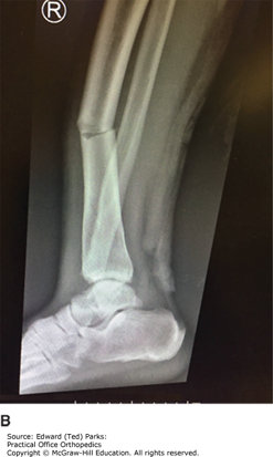 Tibia and Fibula (Tib-Fib) Fracture on X-ray | AccessMedicine Network