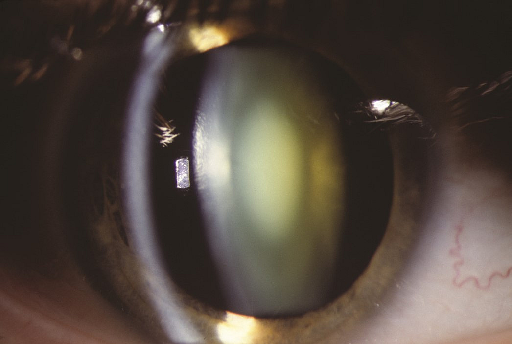 Cataract Diagnosis | AccessMedicine Network