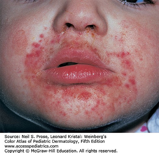 Milia, Miliaria, and Pustular and Acneiform Disorders Diagnosis ...