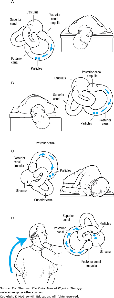 BENIGN PAROXYSMAL POSITIONAL VERTIGO | AccessMedicine Network