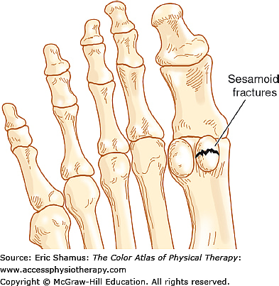 Sesamoiditis | AccessMedicine Network