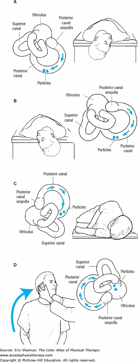 Benign paroxysmal positional vertigo - werysugar